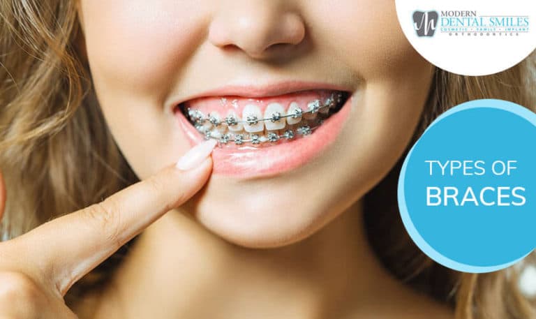 Know The 5 Different Types Of Braces!
